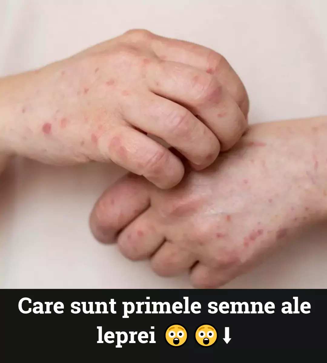 Alertă epidemiologică! Cum se transmite lepra și care sunt semnele că ...